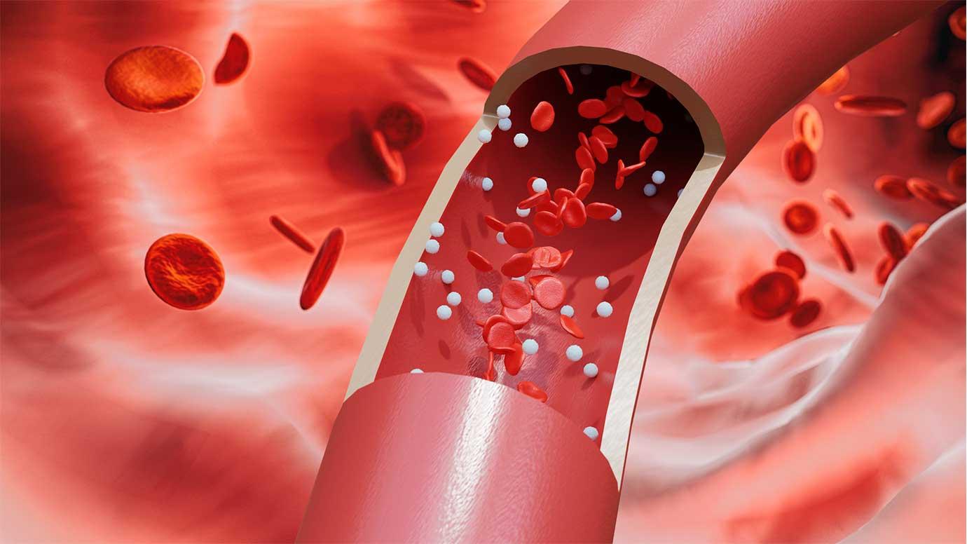 Nanotechnology that clears cholesterol from blood vessels - MedScriptum