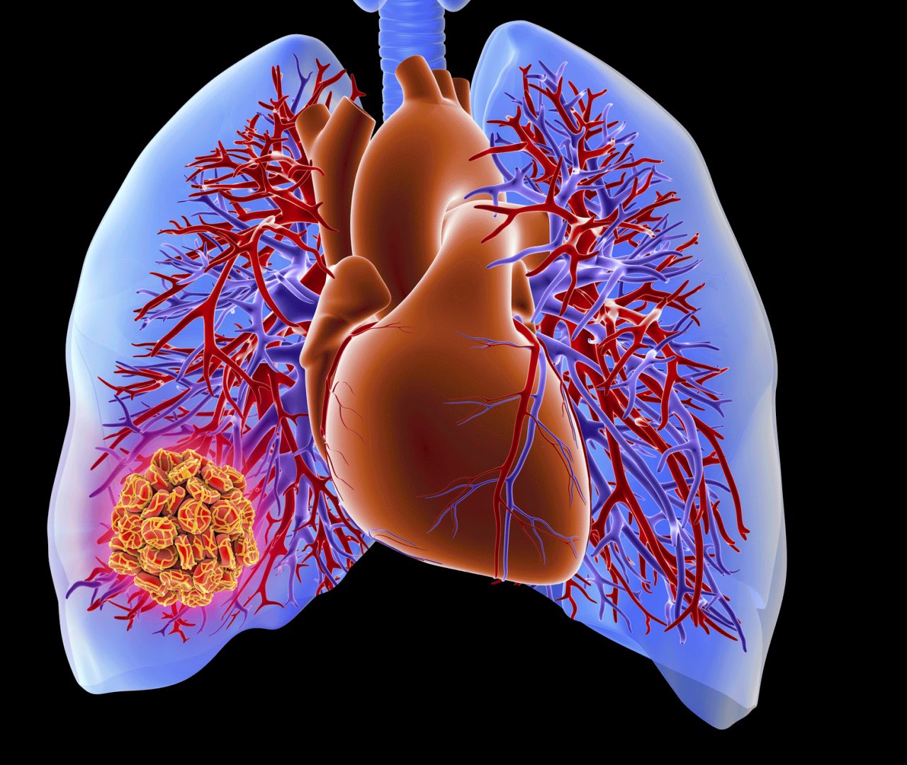 2026 AHA/ACC Guideline for the Management of Acute Pulmonary Embolism ...